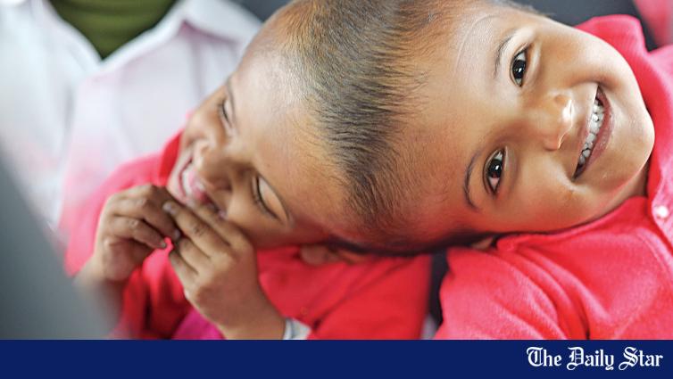 Conjoined twins separated after mega surgery | The Daily Star